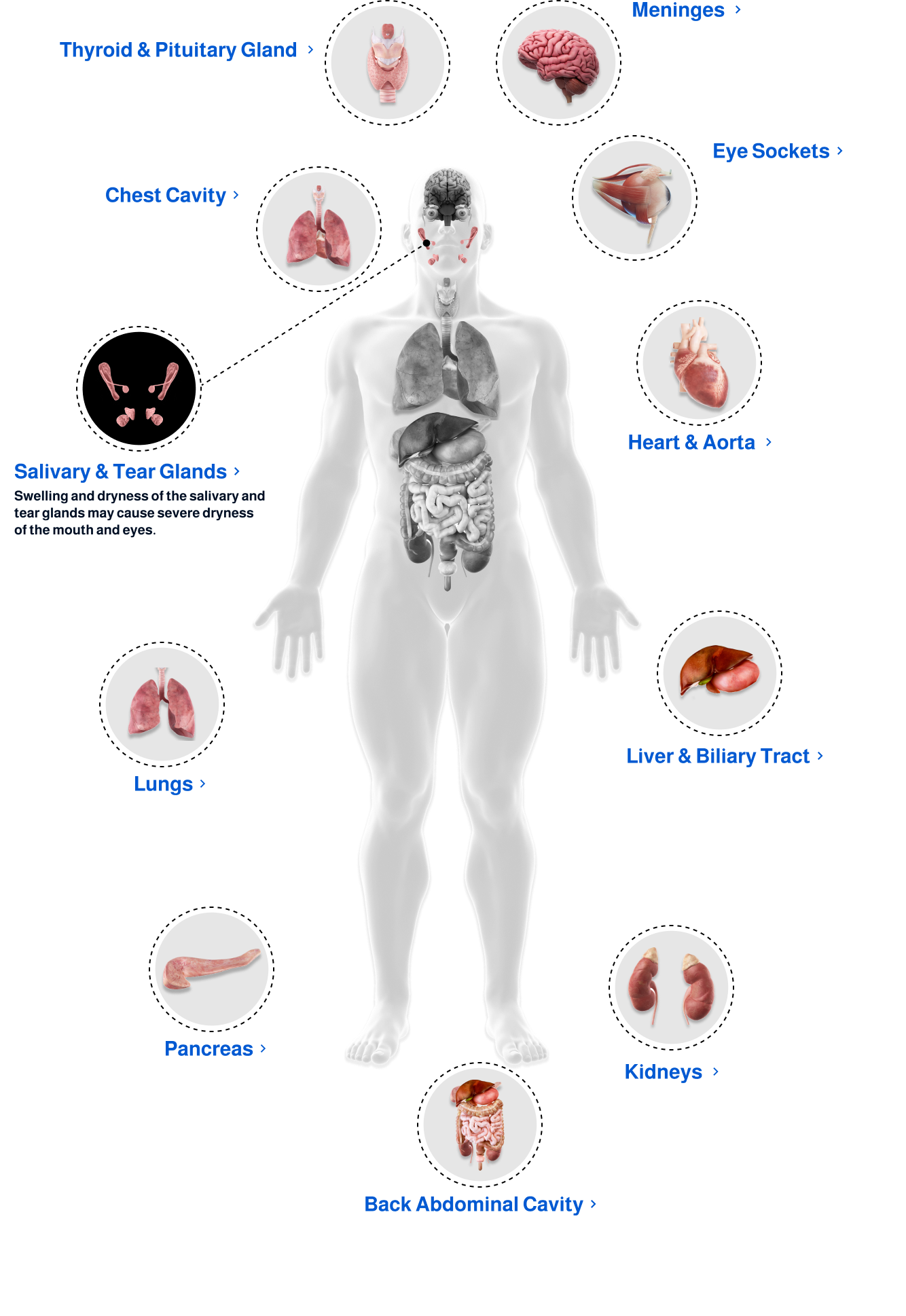 What are the Symptoms of IgG4 Related Disease?